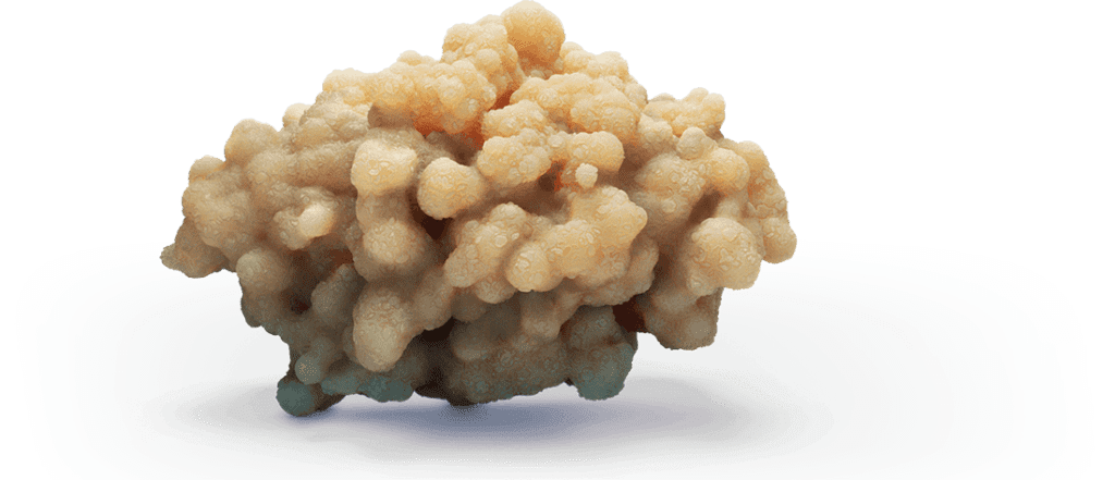 PH1: A Metabolic Kidney Stone Disease | Think PH1™